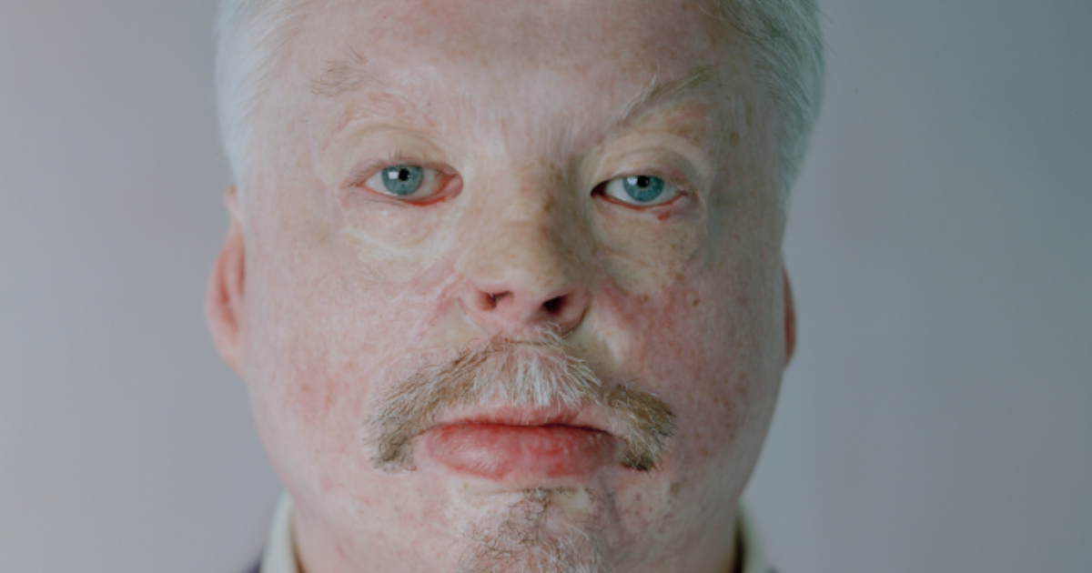 How do we live with scarring? | Scar Free Research